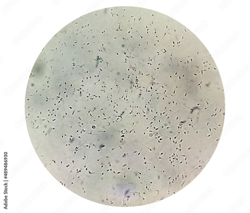 Semen analysis, sperm analysis on microscopic examination Stock Photo ...