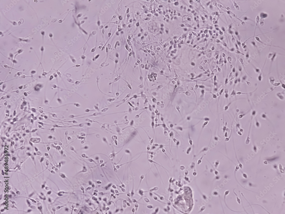Polyzoospermia analyzed by microscope. Semen analysis normal sperm and ...