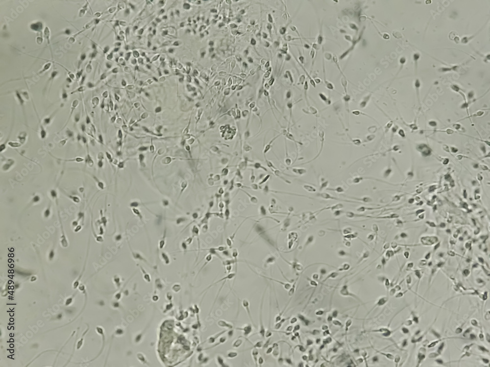 Polyzoospermia analyzed by microscope. Semen analysis normal sperm and ...