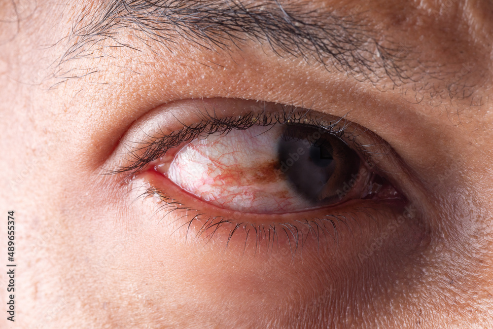 the right eye of the man that looks red Stock Photo | Adobe Stock