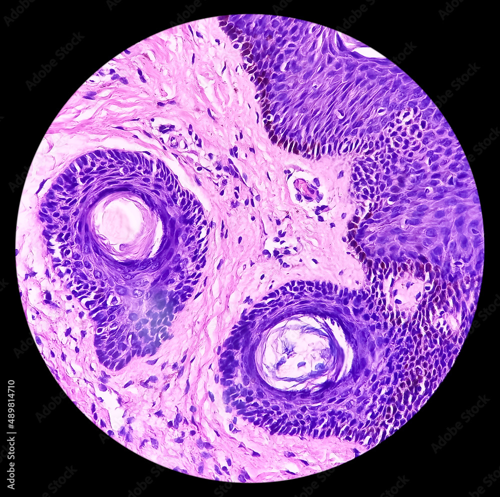 Skin(biopsy): Seborrhoeic keratosis, epidermis show hyperkeratosis ...