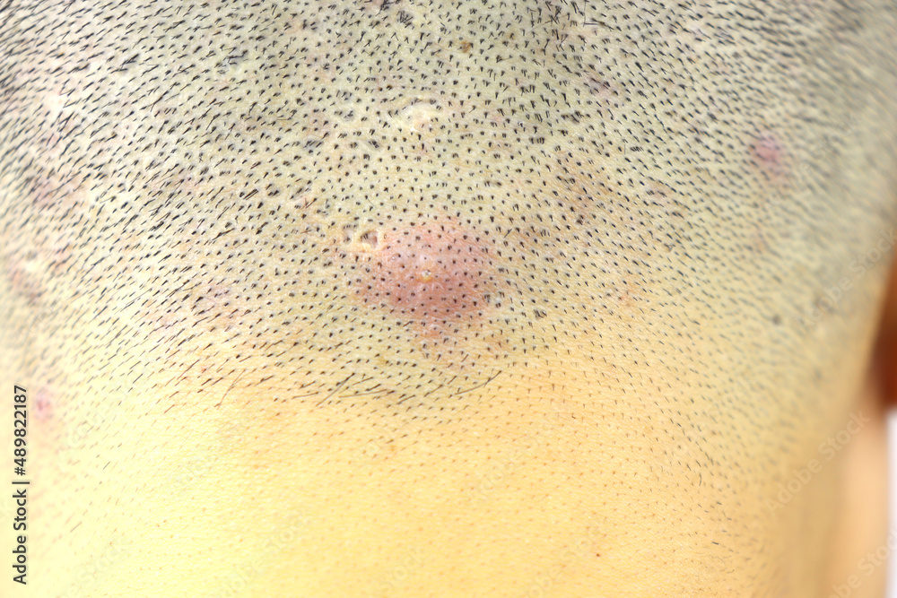 Seborrheic dermatitis. Appears as white, itchy, and scaly dandruff on ...