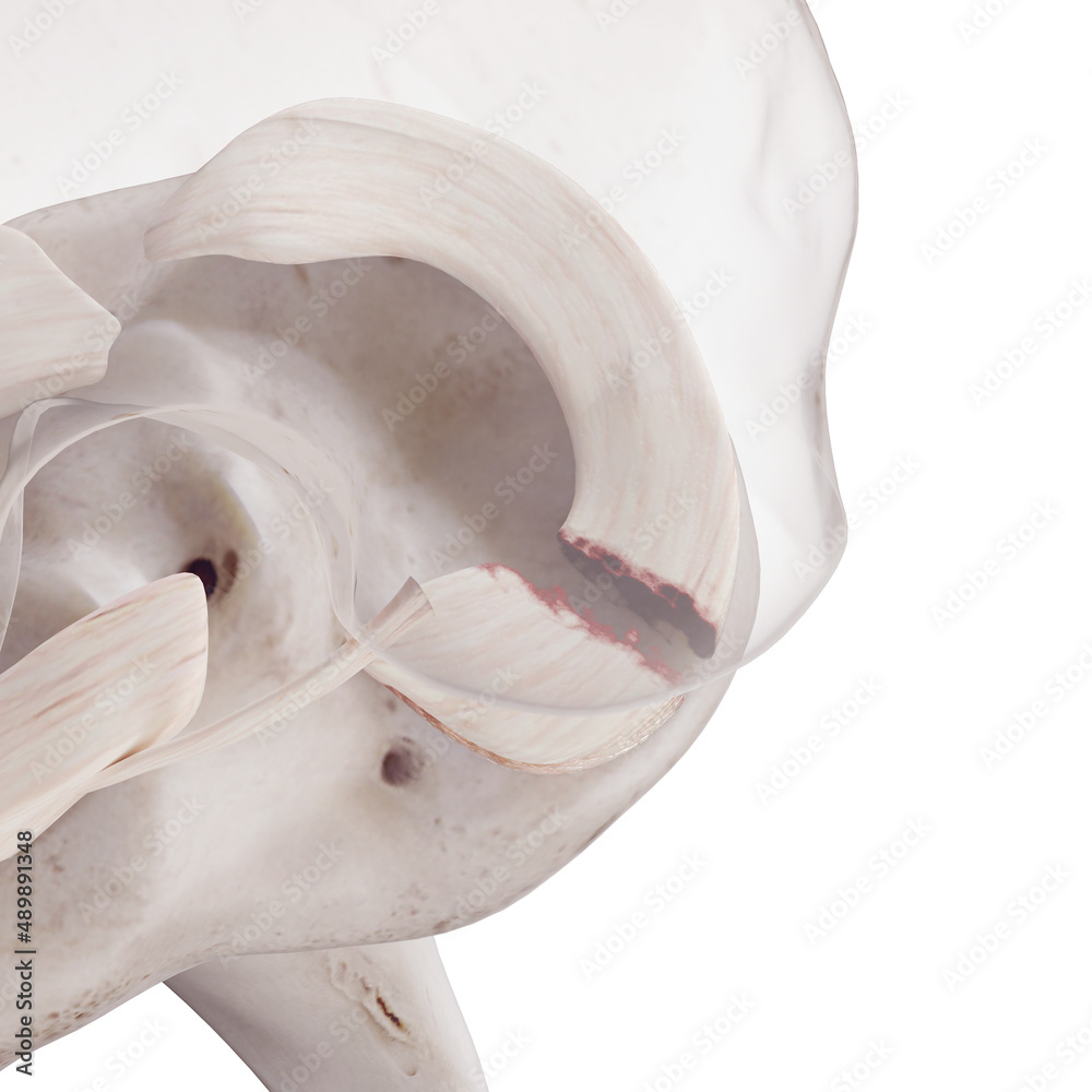 3d rendered medically accurate illustration of a torn medial miniscus ...