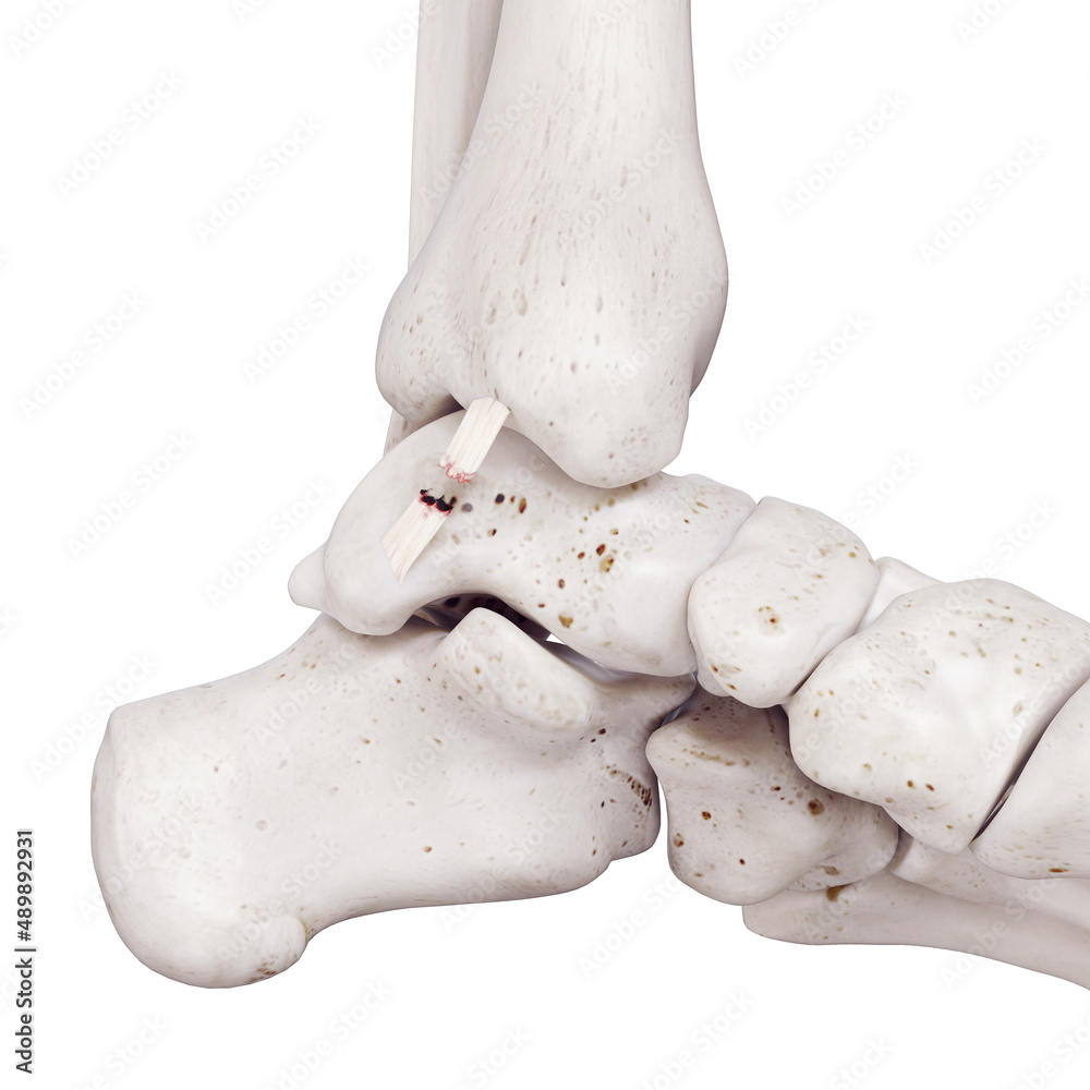 3d rendered medically accurate illustration of a torn posterior ...