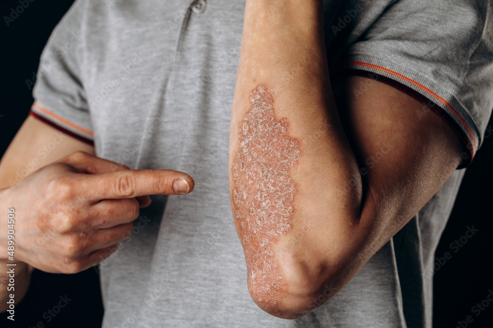 Acute psoriasis on the elbows is an autoimmune incurable dermatological ...