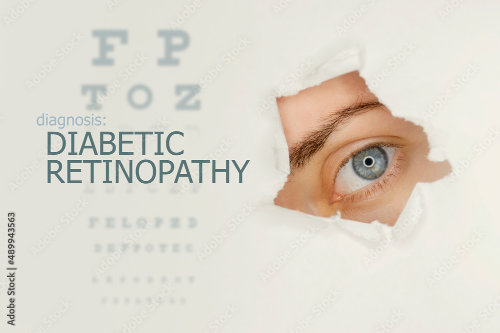 Diabetic retinopathy disease poster with eye test chart and blue eye ...