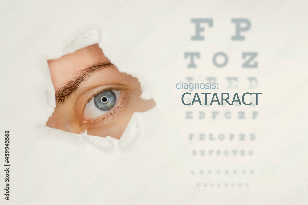 Cataract disease poster wwith eye test chart and blue eye on left ...