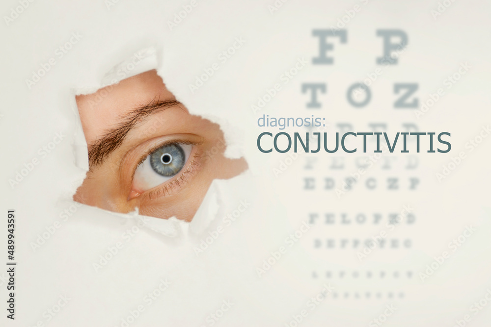 Conjuctivitis disease poster with eye test chart and blue eye on right ...