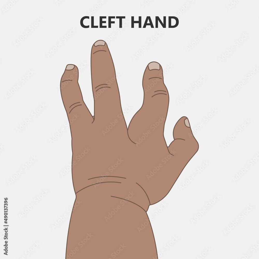 Cleft Hand