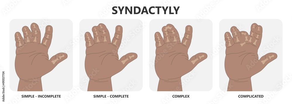 Hand finger gene prader willi band autism surgery baby simple thumb ...