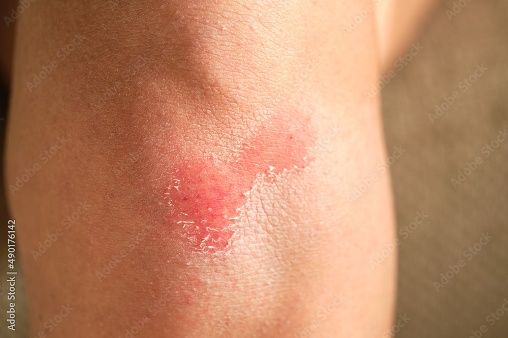 red wound on the knee Stock Photo | Adobe Stock