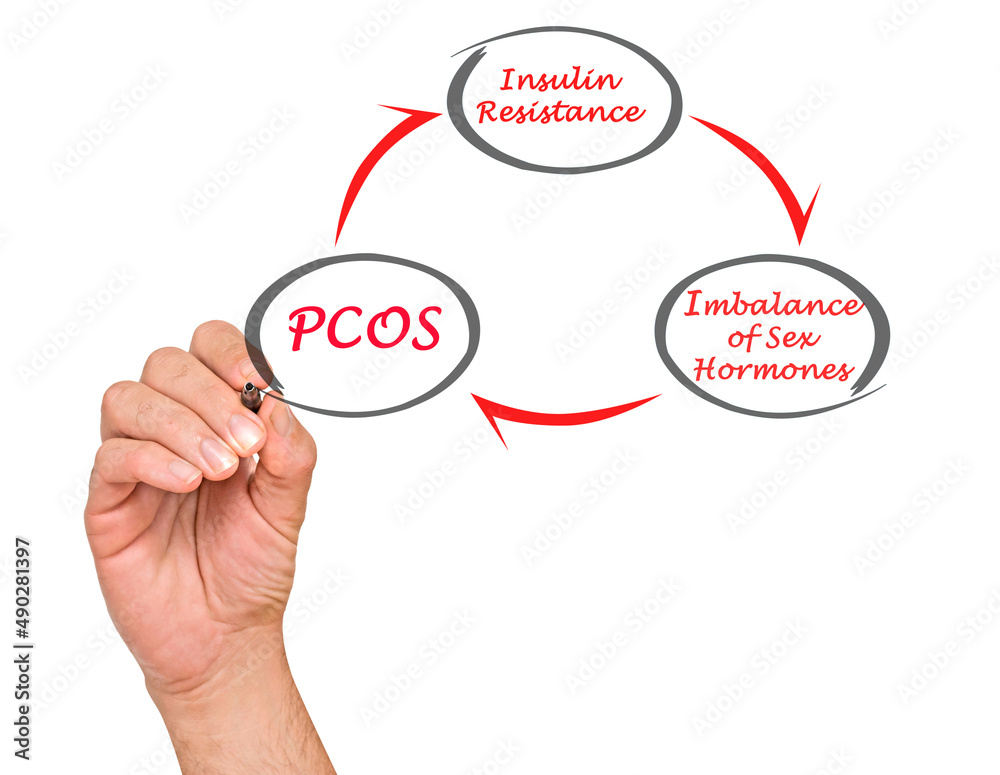 Presenting Cycle leding to PCOS Stock Photo | Adobe Stock