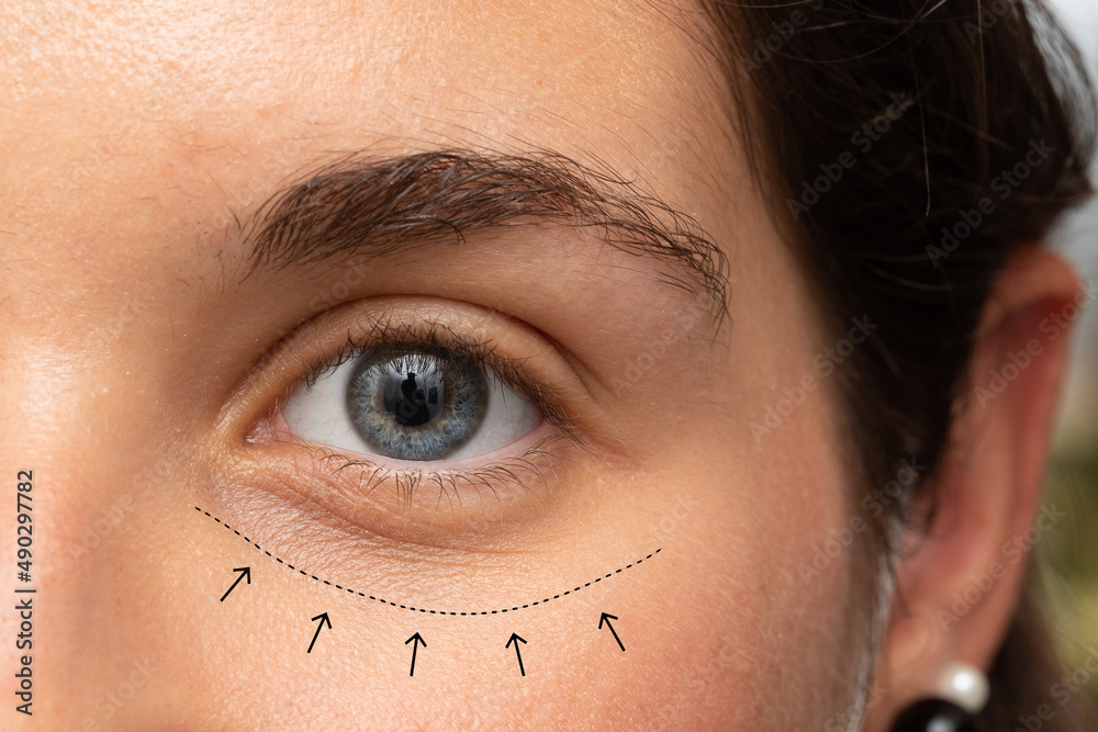 girl eye with lines and arrows indicating the correction of aesthetic ...