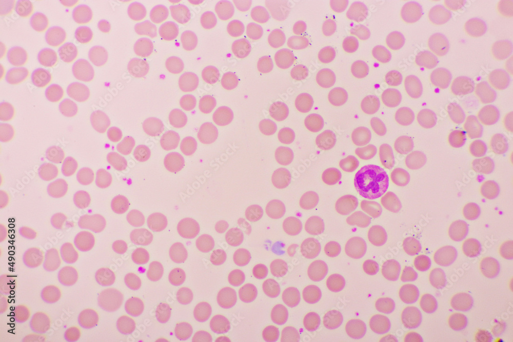 Essential thrombocytosis blood smear, present abnormal high platelet ...