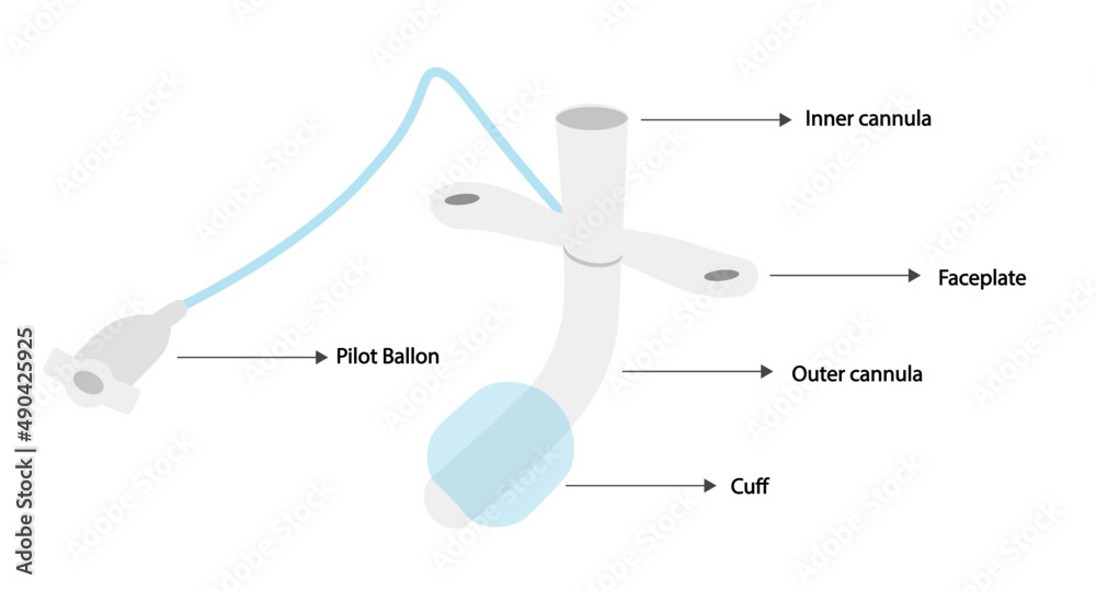 Tracheostomy device anatomy. Tracheostomy insuflated cuff. Stock Vector ...