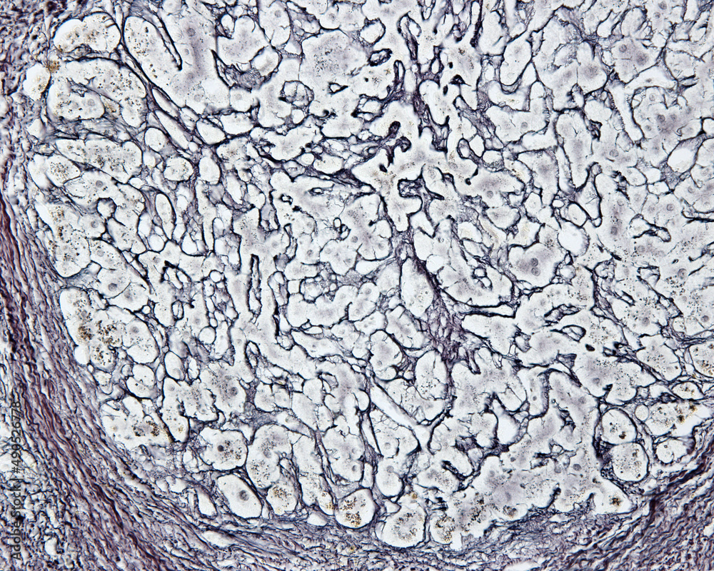 Human liver. Cirrhosis. Silver stain Stock Photo | Adobe Stock