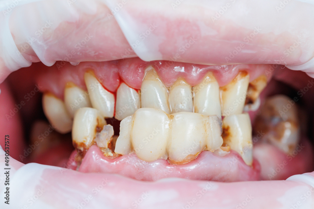 Spoiled teeth, poor dental hygiene, caries, Mouth disease. shattered ...