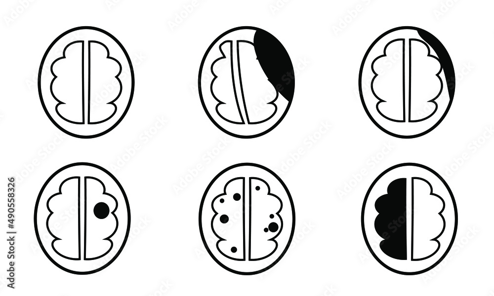 Infographic of lesion or pathology of ct brain Stock Vector | Adobe Stock