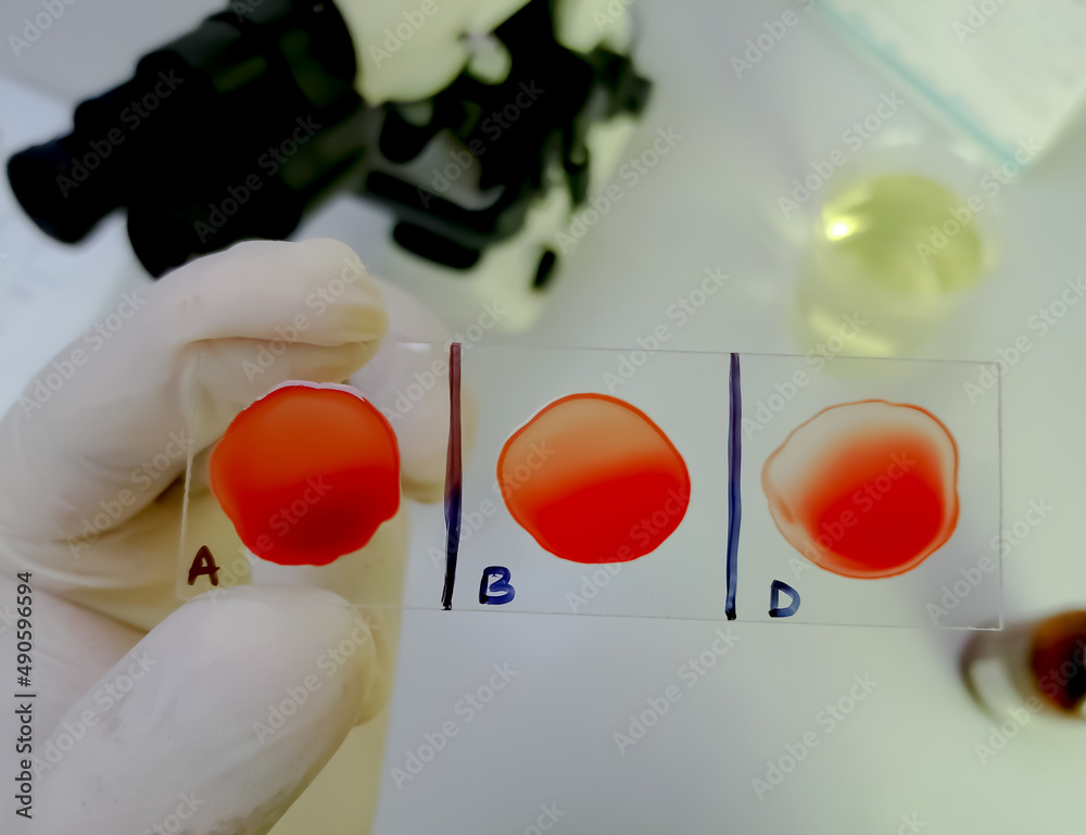 Blood group and Rh factor testing by slide agglutination method showing ...