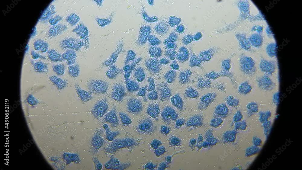 Antitumor activity experiment. Human cells under the microscope ...