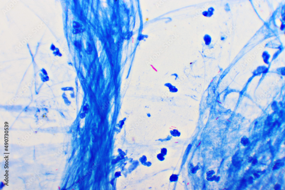 Mycobacterium tuberculosis positive (small red rod) in sputum smear ...