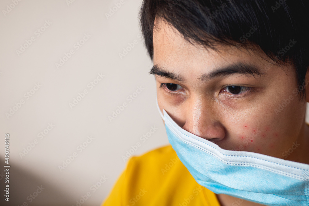 Acne on the face. It is an allergic reactions from heat and humidity of ...