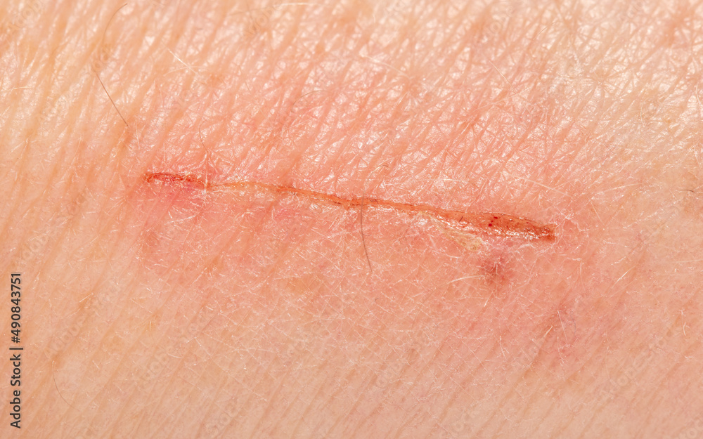 Wound on human skin as a background. Stock Photo | Adobe Stock