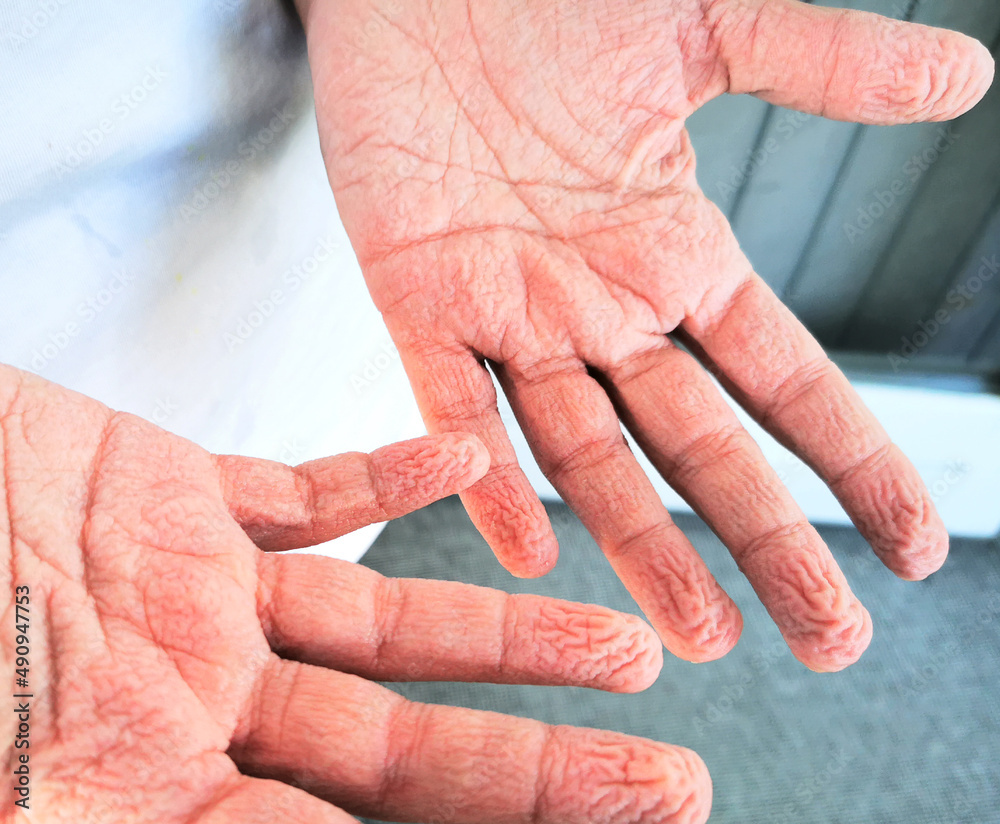 Wrinkled Skin From Water