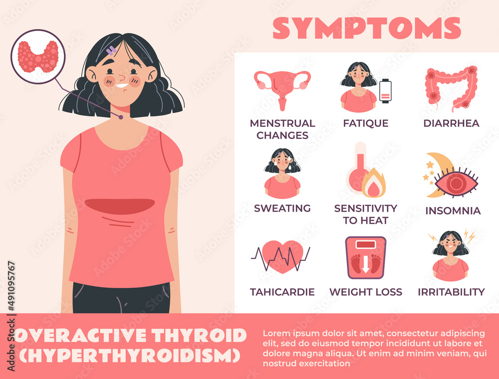 Hyperthyroidism infographic isolated concept. Vector flat graphic ...