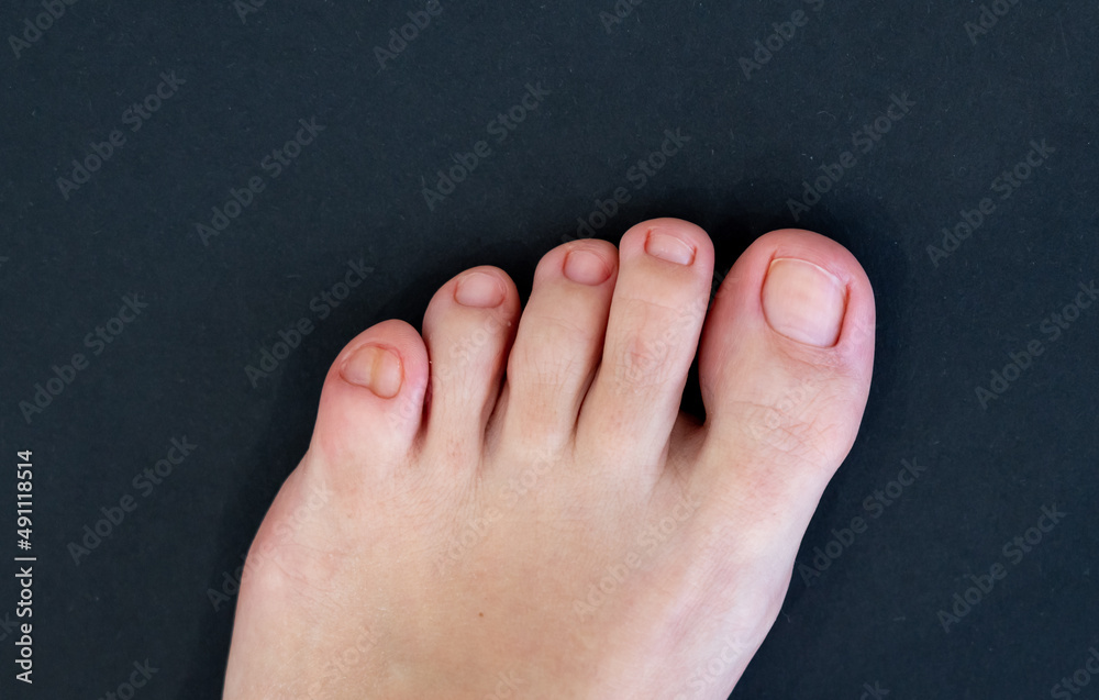 Female feet with big double little toe on black background Stock Photo ...