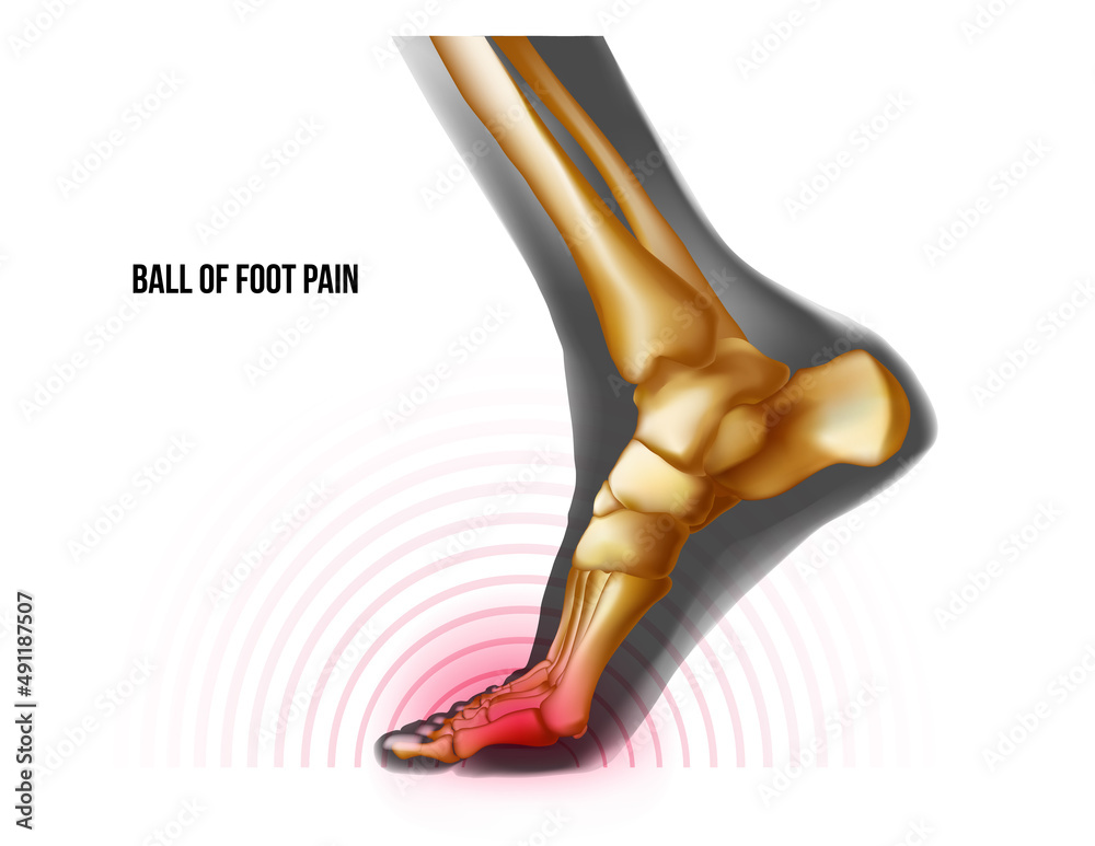 Ball of foot pain bones skeleton realistic anatomy illustration Stock ...