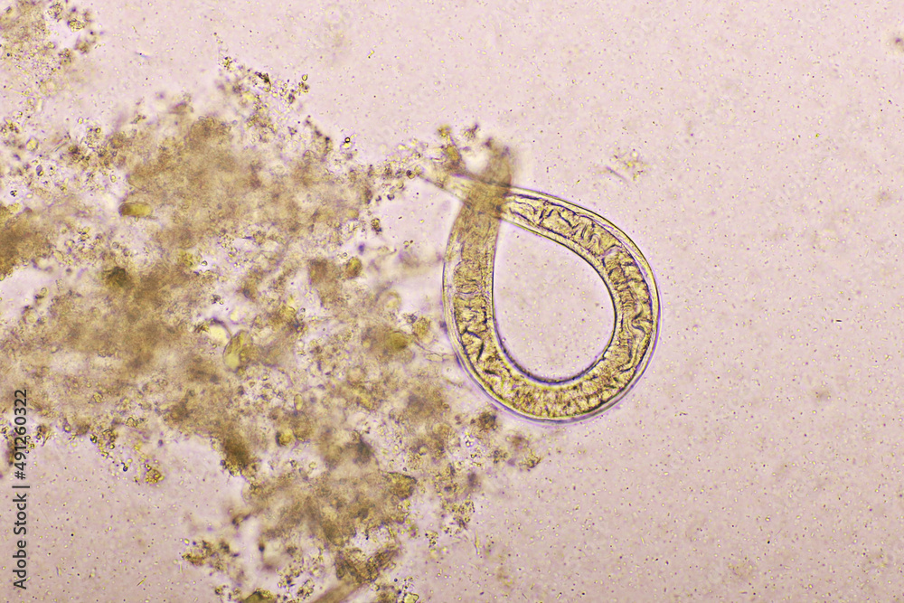 Threadworm Strongyloides In Humans