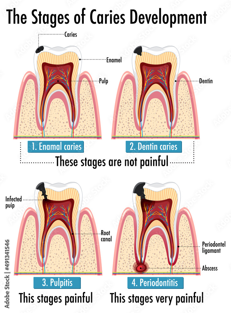 Infographic of human in stages of caries development Stock Vector ...