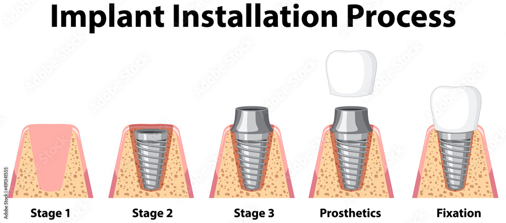Infographic of human in implant installation process Stock Vector ...
