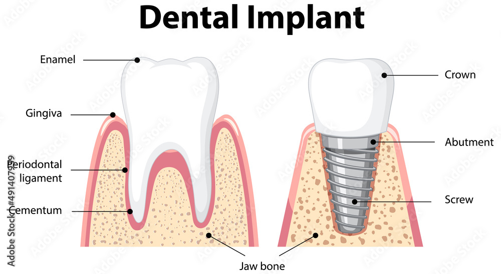 Infographic of human in structure of the dental implant Stock Vector ...