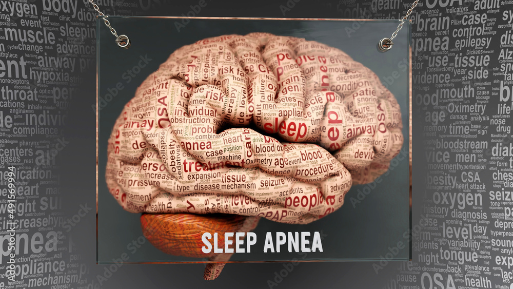 Sleep apnea anatomy - its causes and effects projected on a human brain ...