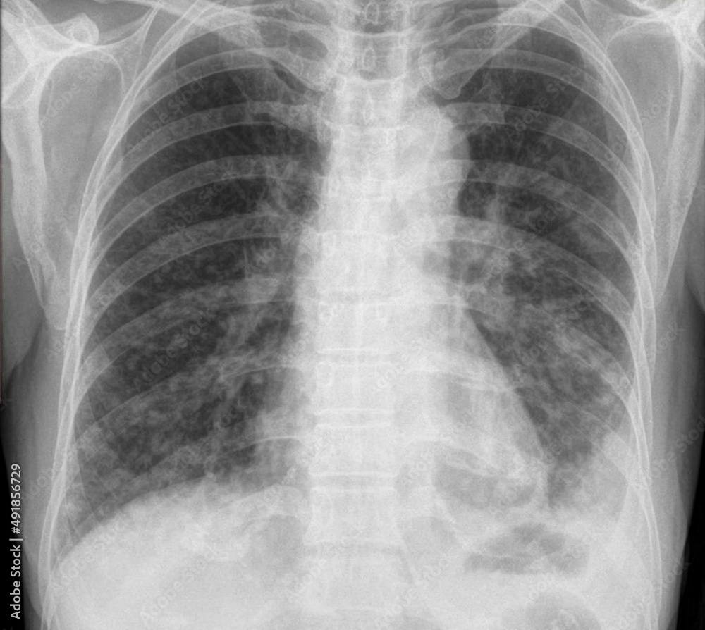 chest x-ray image of miliary nodules Stock Photo | Adobe Stock