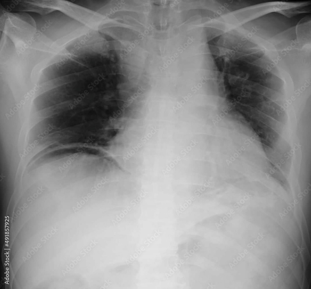 Chest x ray image of pneumoperitoneum ,free air on abdomen as luscent ...