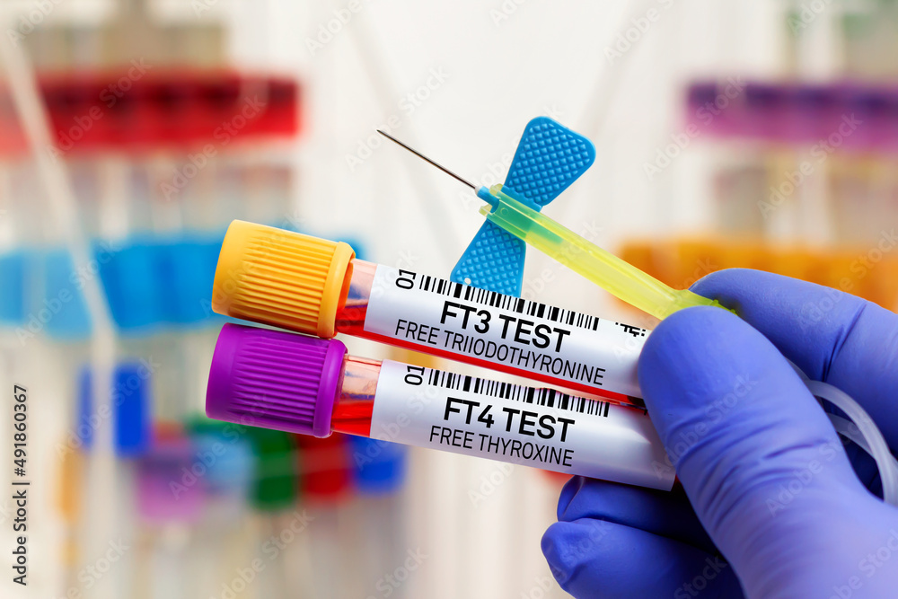 Blood sample for study of FT3 Free triiodothyronine and FT4 Free ...