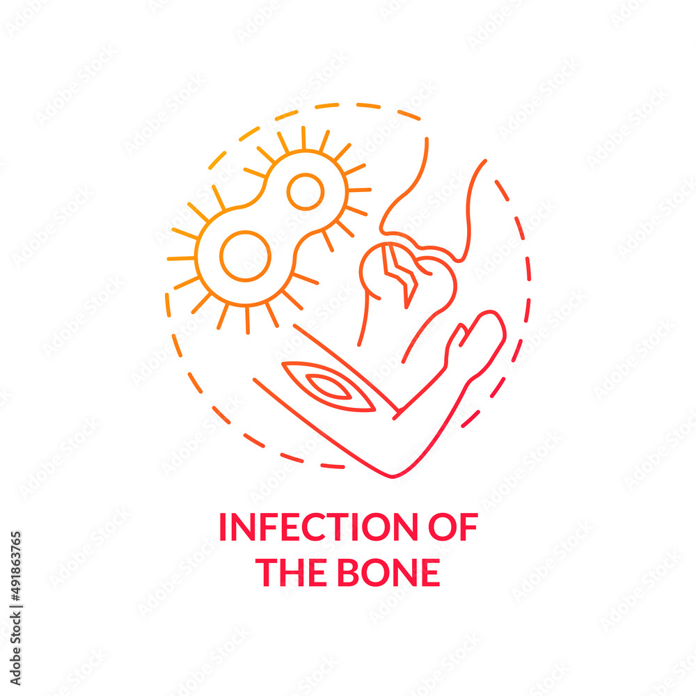 Infection of bone red gradient concept icon. Common joint condition ...
