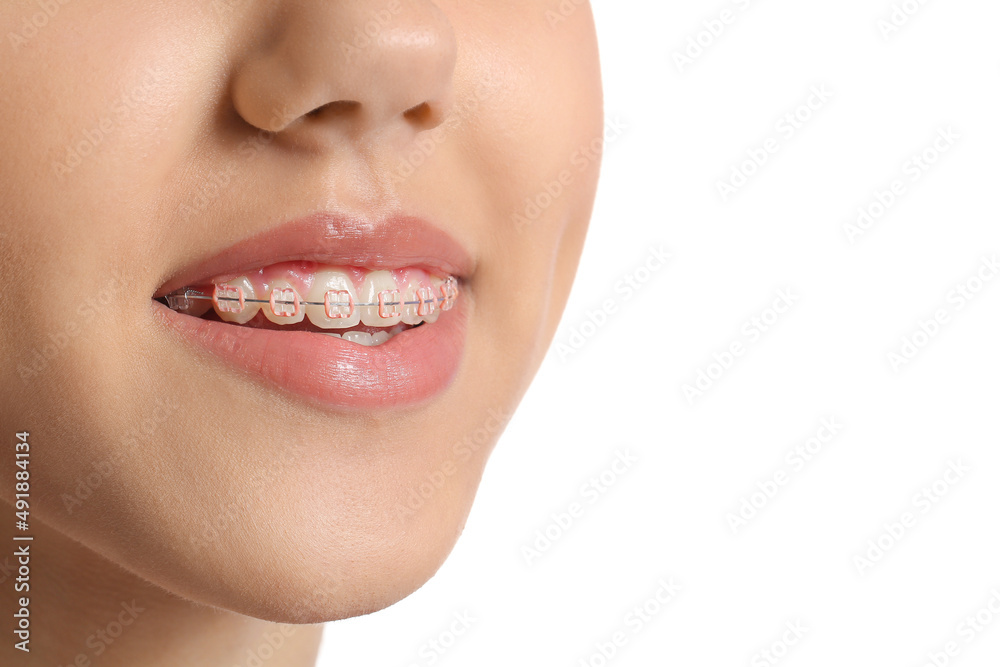 Teeth of young woman with dental braces on white background, closeup ...