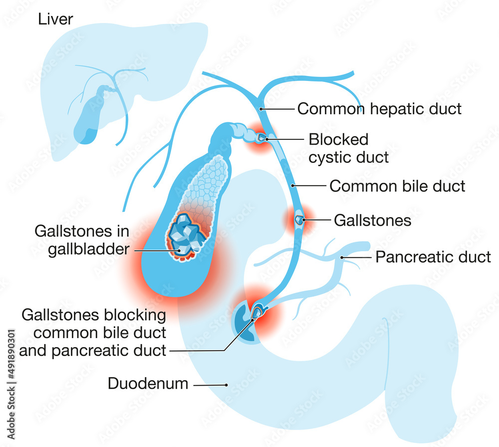 Gallstone disease. gallstones blocking bile duct and pancreatic duct ...