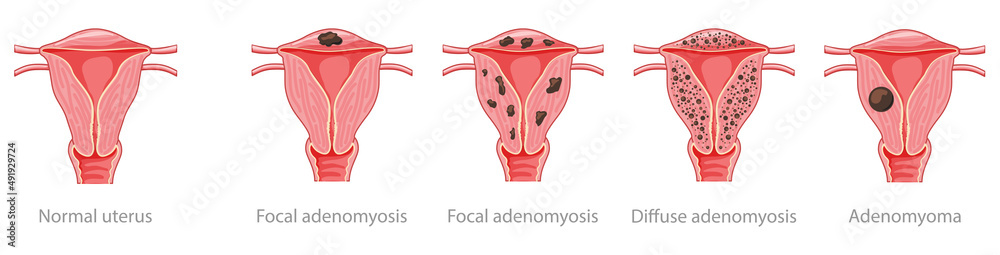 Obraz Adenomyosis Focal, Diffuse, Adenomyoma and normal uterus Human ...