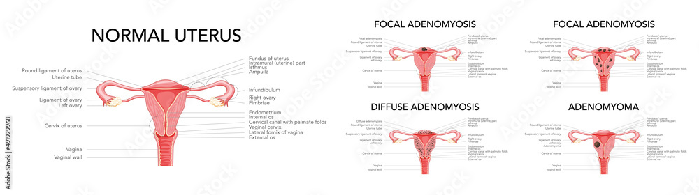 Adenomyosis illness set - focal, diffuse, adenomyoma and normal uterus ...