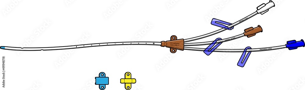 Poster Central Venous Catheter (triple-lumen) – Wall Art | UkPosters