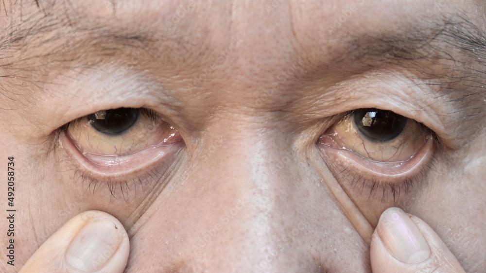 Pale skin of Asian man. Sign of anemia. Pallor at eyelid. Stock Photo ...