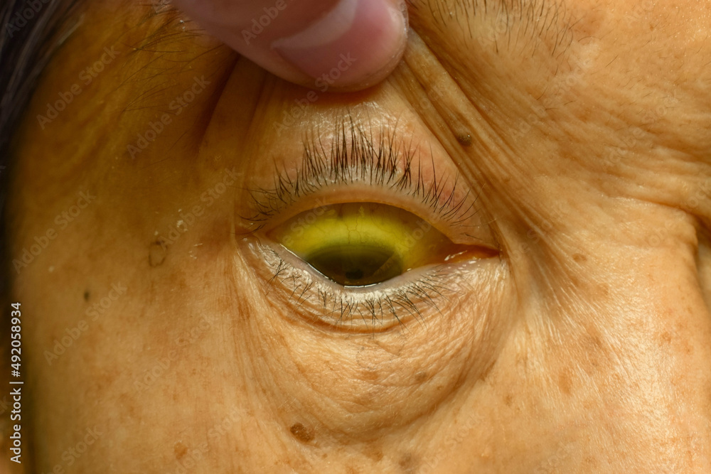 Deep jaundice in Asian female patient. Yellowish discoloration of skin ...