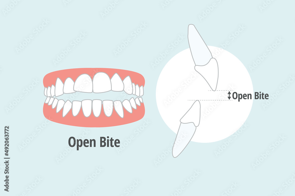 icon dental problem. vectorial illustration Open bite Stock Vector ...