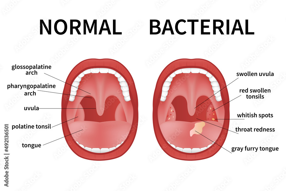 Bacterial and viral tonsillitis. Angina, pharyngitis, and tonsillitis ...