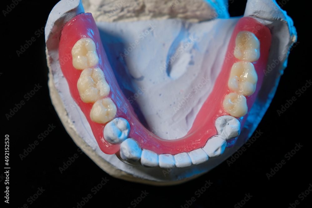 Removable plastic partial denture on white background Stock Photo ...